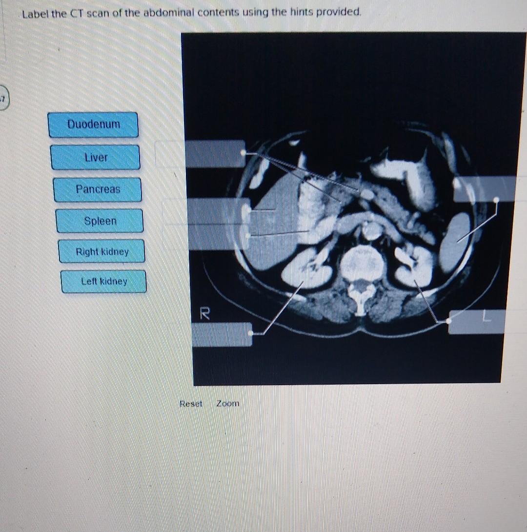 Solved Label the CT scan of the abdominal contents using the | Chegg.com