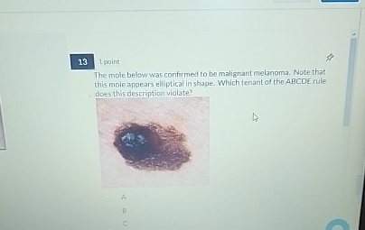 Solved 1 ﻿point The mole below was confrmed to be malignant | Chegg.com