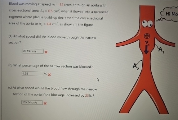 Solved Blood was moving at speed, v1=12cms, ﻿through an | Chegg.com