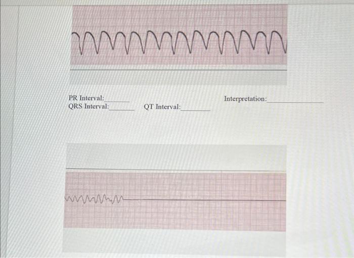 Solved PR Interval: Interpretation: QRS Interval: QT | Chegg.com