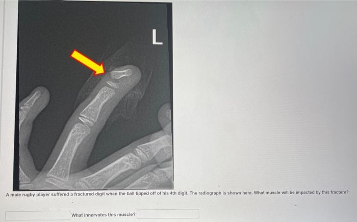 Solved L A male rugby player suffered a fractured digit when | Chegg.com
