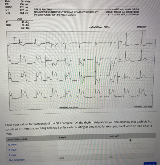 Enter your values for each peak of the QRS complex. | Chegg.com