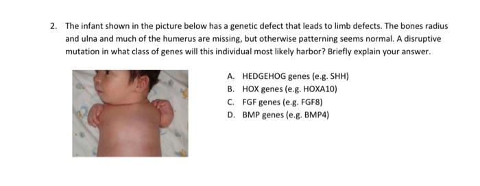 Solved The infant shown in the picture below has a genetic | Chegg.com