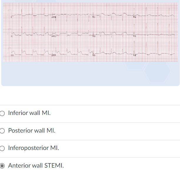Solved A patient has the following EKG. What is your | Chegg.com