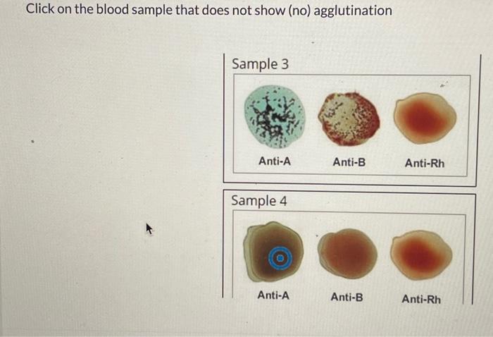 Solved Click on the blood sample that does not show (no) | Chegg.com