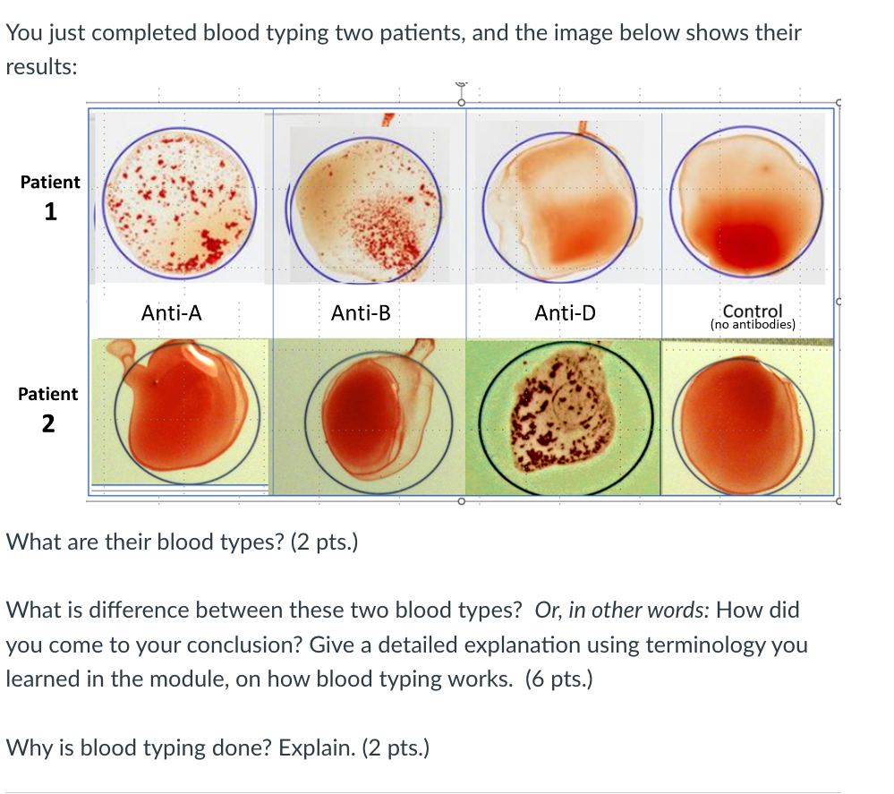 Solved You just completed blood typing two patients, and the | Chegg.com