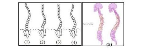 Solved Draw three point pressure system for each deformity | Chegg.com