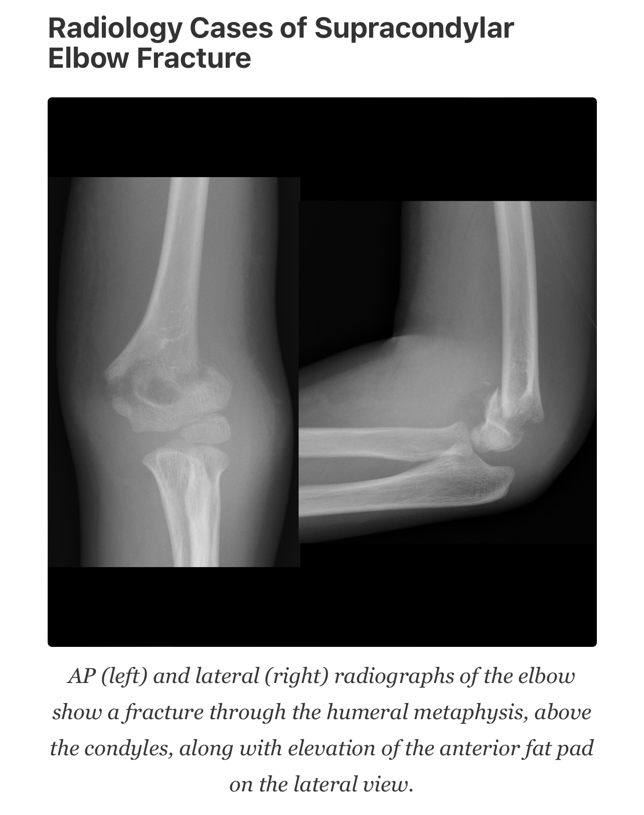 Solved Radiology Cases of Supracondylar Elbow FractureAP | Chegg.com