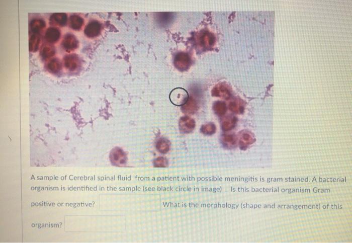 Solved A sample of Cerebral spinal fluid from a patient with | Chegg.com