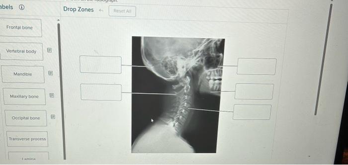 Solved abels (1) Drop Zones Peset Aut Frontal bone Vertebral | Chegg.com
