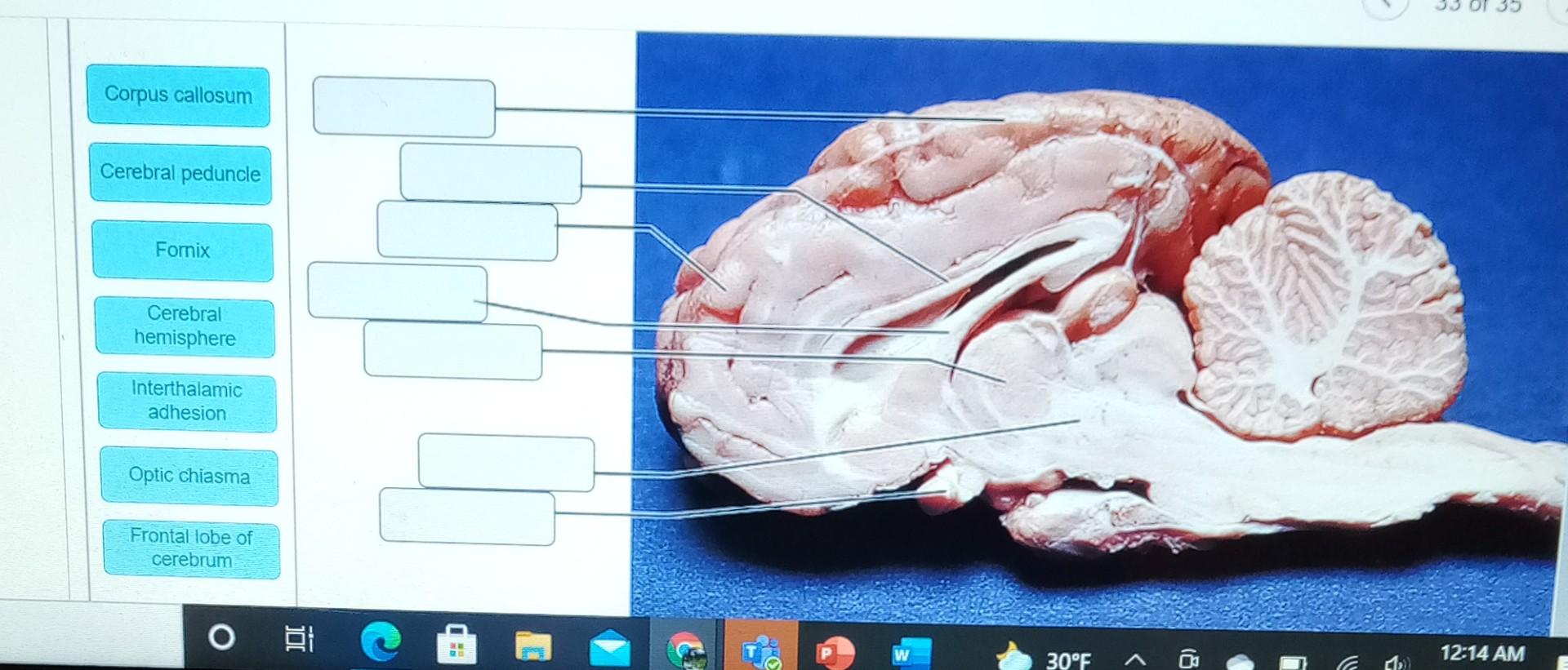 Solved Corpus callosum Cerebral peduncle Fornix Cerebral | Chegg.com
