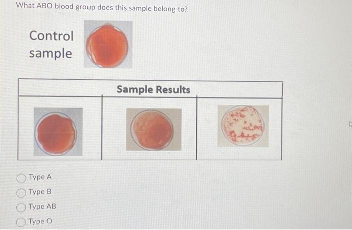 Solved What ABO blood group does this sample belong to? | Chegg.com