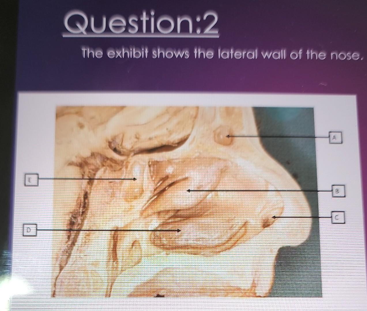 [Solved]: The exhibit shows the lateral wall of nos