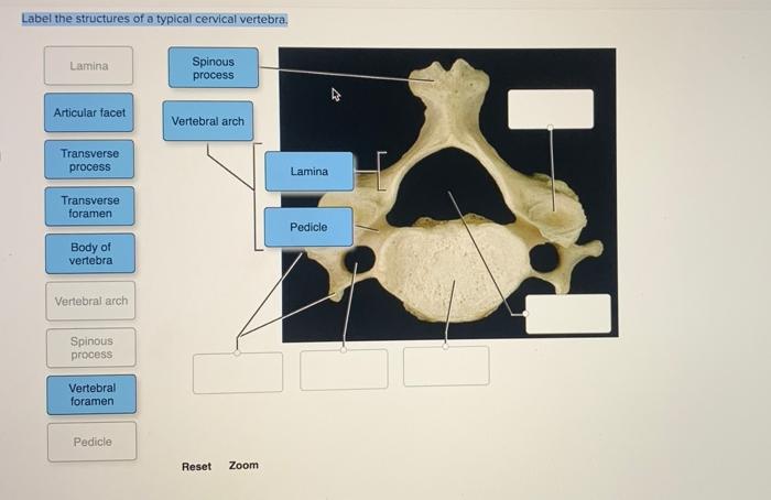 Solved Label the structures of a typical cervical vertebra, | Chegg.com