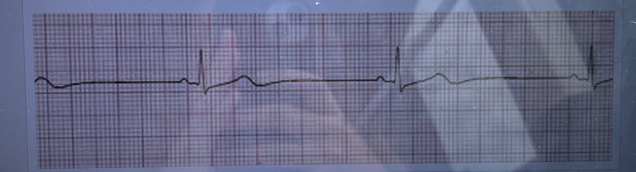 Solved What is the rhythm and heart rate | Chegg.com