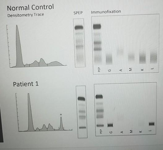 Normal Control Densitometry Trace SPEP Immunofixation | Chegg.com
