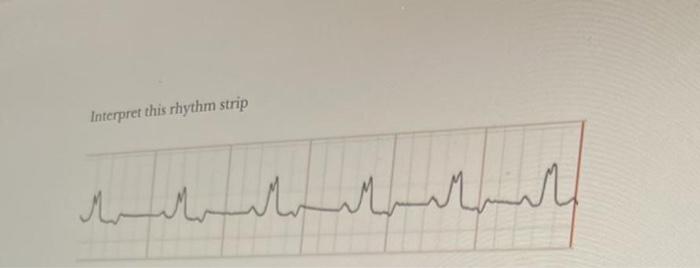 Interpret this rhythm strip | Chegg.com