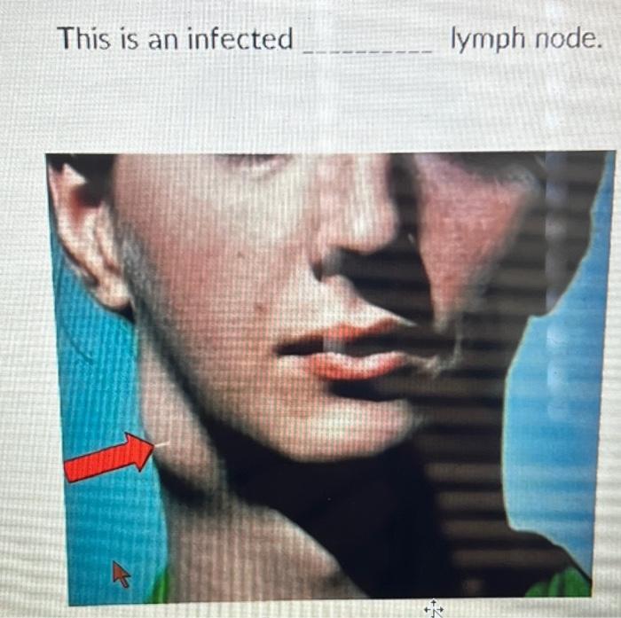 Solved This Is An Infected Lymph Node Chegg