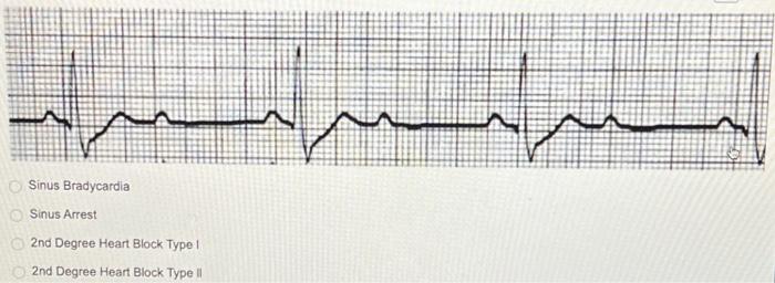 Solved 2nd Degree Heart Block Type 1 Sinus Bradycardia | Chegg.com