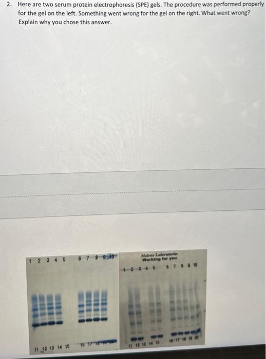 Solved 2. Here are two serum protein electrophoresis (SPE) | Chegg.com