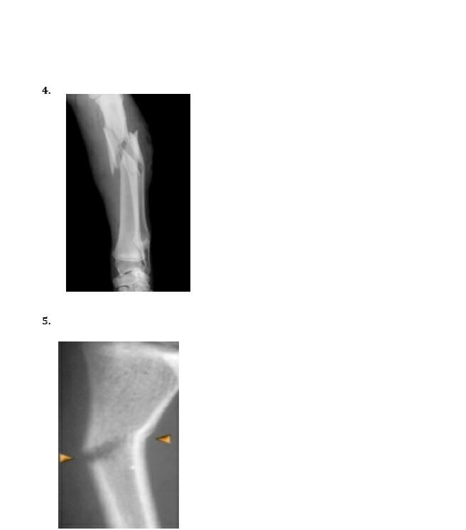 Solved TYPES OF FRACTURES Match the fractures pictured to | Chegg.com