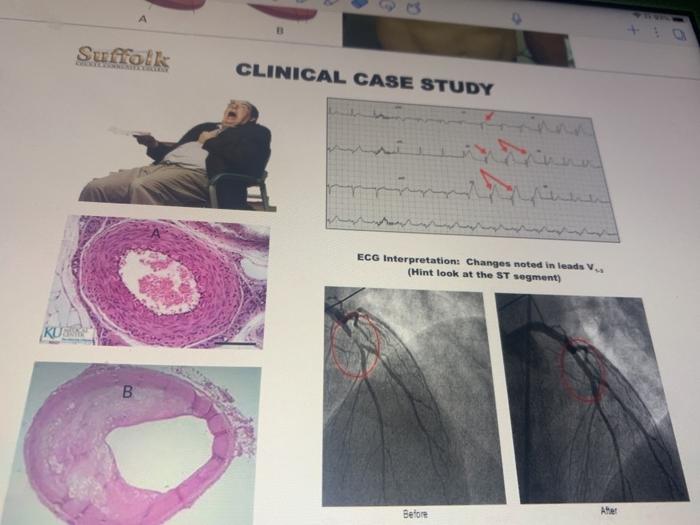 Solved Sufolk CLINICAL CASE STUDY ECG Interpretations | Chegg.com