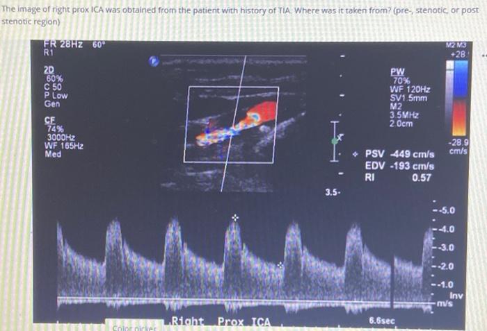 This internal carotid artery (ICA) spectral waveform | Chegg.com