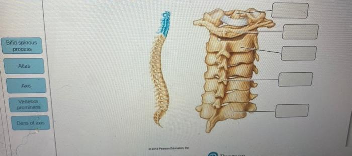 Solved Bifid spinous process Atlas Asos Vertebra prominen | Chegg.com