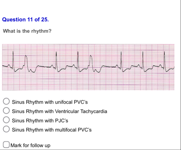 Solved Question 11 ﻿of 25.What is the rhythm?Sinus Rhythm | Chegg.com