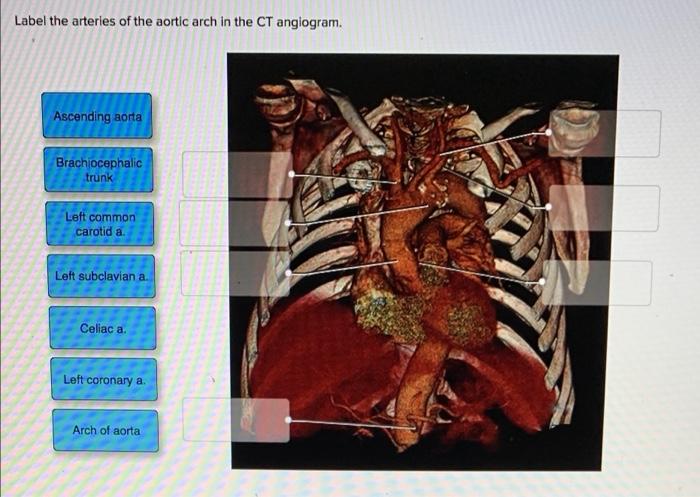 Solved Label the arteries of the aortic arch in the CT | Chegg.com