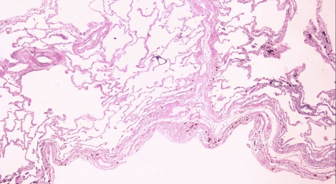 Solved In the following photo is a human pulmonary emphysema | Chegg.com