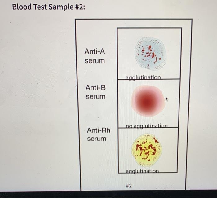 Solved Blood Test Sample #2: Anti-A serum agglutination | Chegg.com