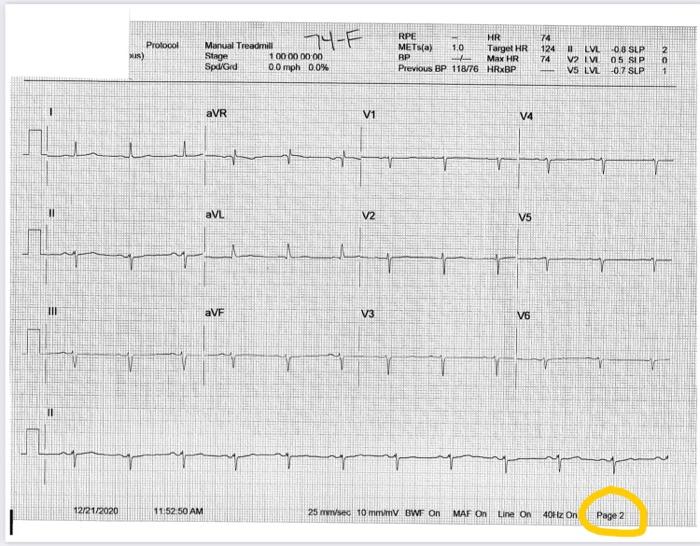 I need help reading and interpreting 12-Lead EKG's As | Chegg.com