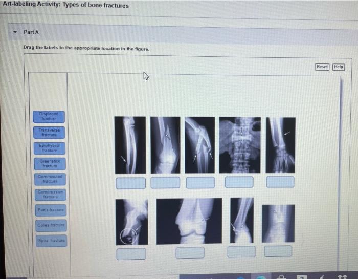 Solved Art-labeling Activity: Types of bone fractures Part A | Chegg.com
