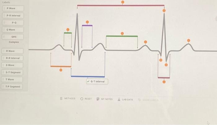Labels P Wave P-R Interval P-Q Q Wave QRS Complex R | Chegg.com