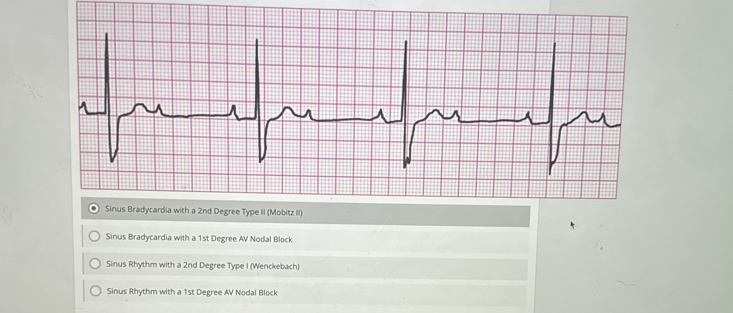 Solved Sinus Bradycardia with a 2nd Degree Type II (Mobitz | Chegg.com