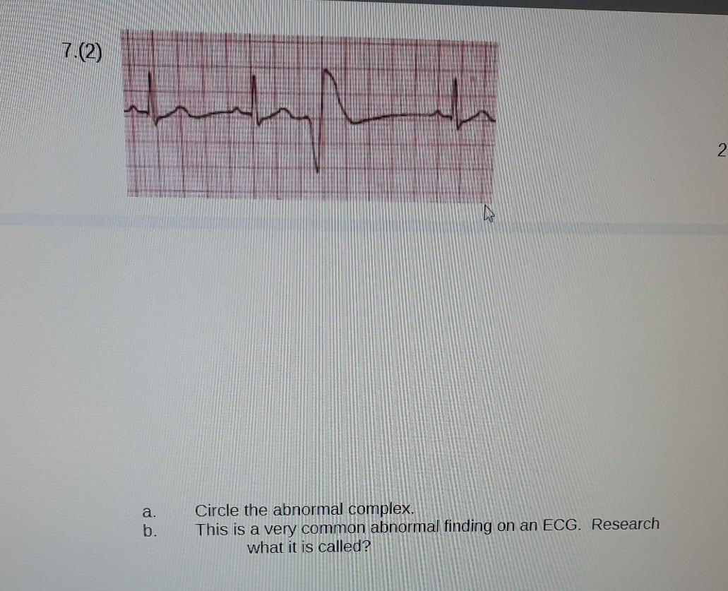 Solved 1.(5) On the ECG pictured below, match the following | Chegg.com