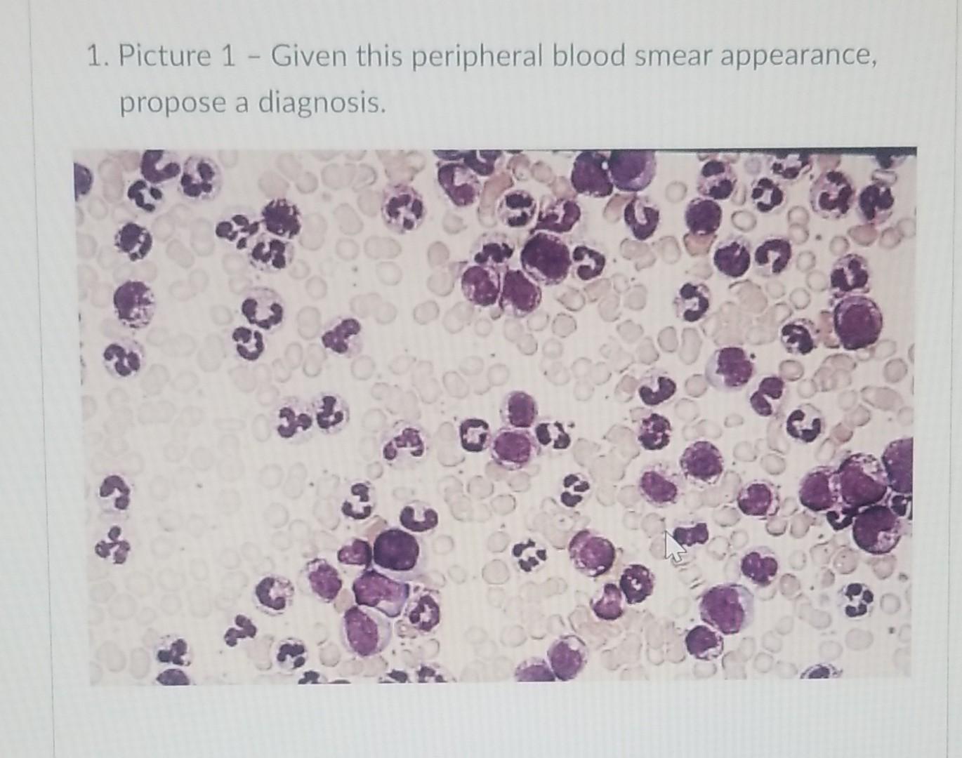 Solved 1. Picture 1 - Given this peripheral blood smear | Chegg.com