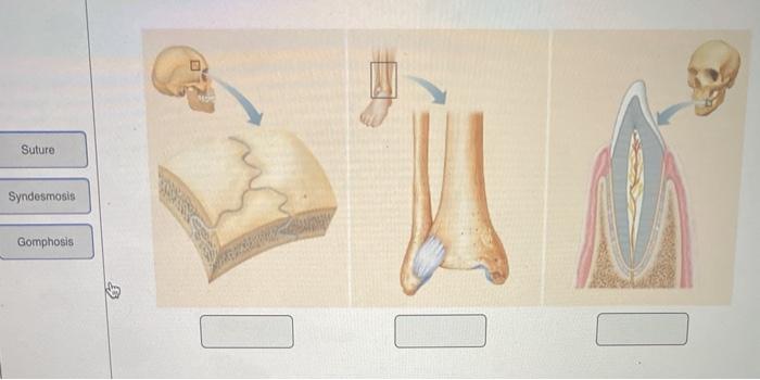 Solved Suture Syndesmosis Gomphosis | Chegg.com