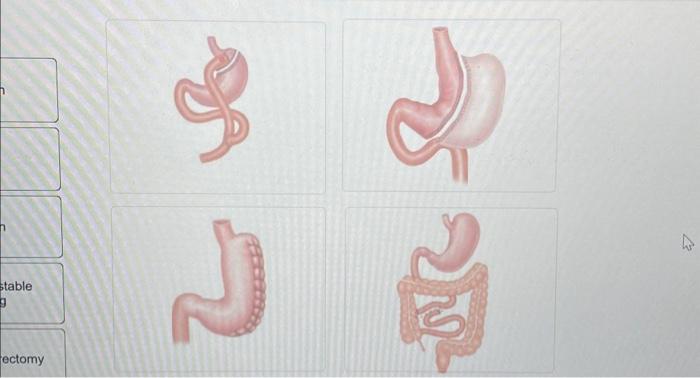 Solved label the following types of bariatric surgery. IIeal | Chegg.com