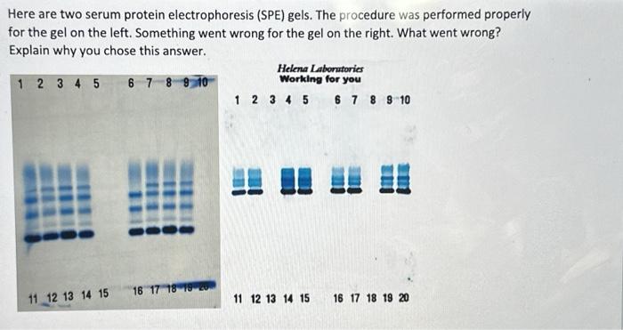 Solved Here are two serum protein electrophoresis (SPE) | Chegg.com