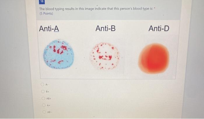 Solved 18 The blood typing results in this image indicate | Chegg.com