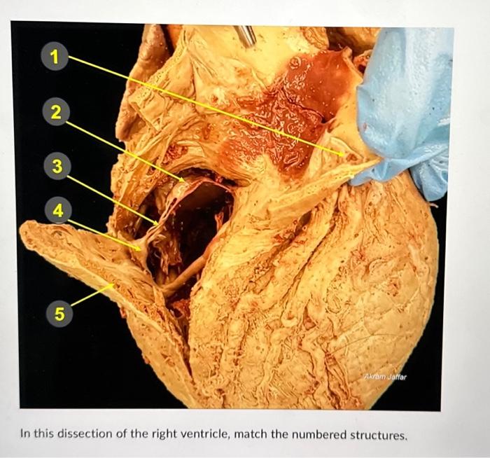 Δ]In this dissection of the right ventricle, match | Chegg.com