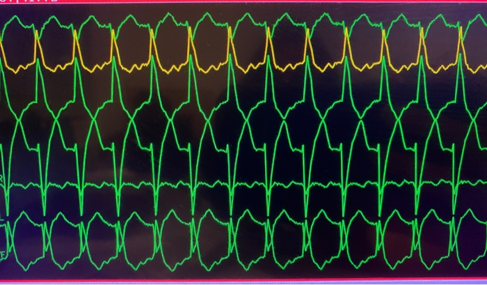 Solved which heart rhythm is this? Is it Ventriclular tachy | Chegg.com