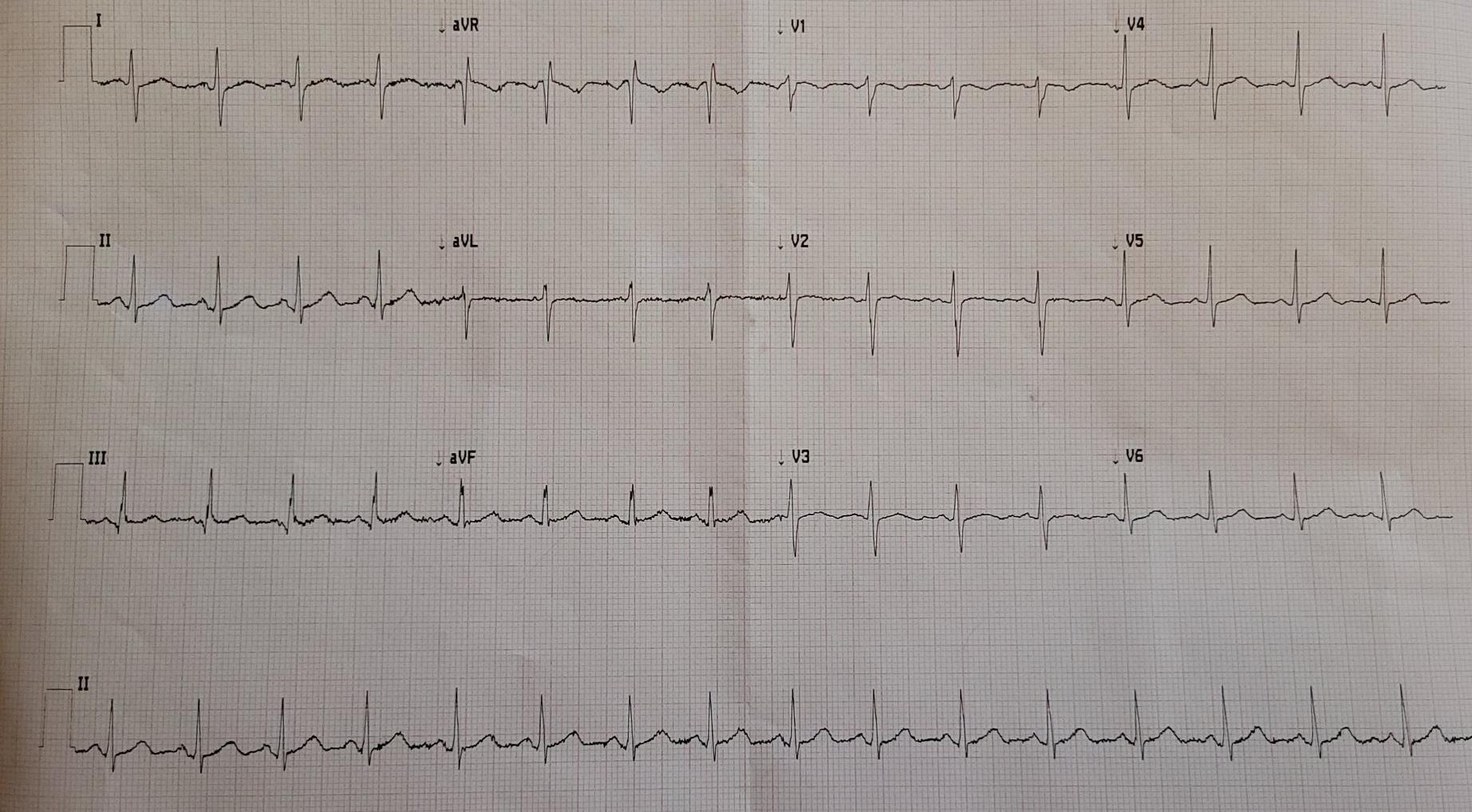 Solved what is the twave what is the p wave what is the | Chegg.com