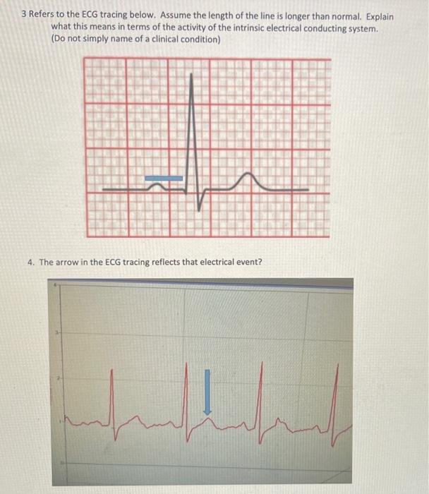 Solved 1-2. Refers to the electrocardiogram (ECG) tracing | Chegg.com