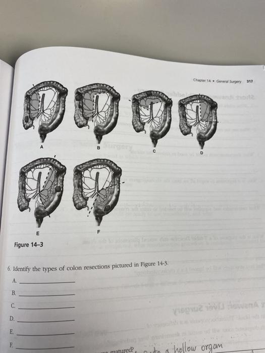 (Solved) - Identify the types of colon resections pictured in Figure 14 ...