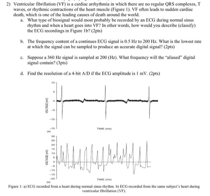 Solved 2) Ventricular fibrillation (VF) is a cardiac | Chegg.com