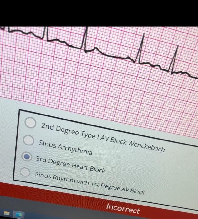 Solved 2nd Degree Type I AV Block, Wenckebach 3rd | Chegg.com