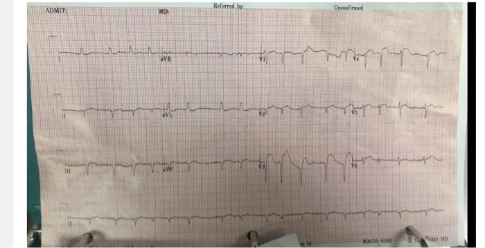 Solved Is the ECG rhythm regular or irregular? Calculate the | Chegg.com